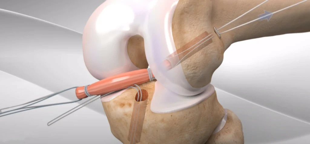 Knee ligament reconstruction in Nagarbhavi |Knee Ligament Repair