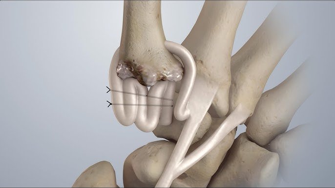 Ligament reconstruction and tendon interposition in Vijayanagar